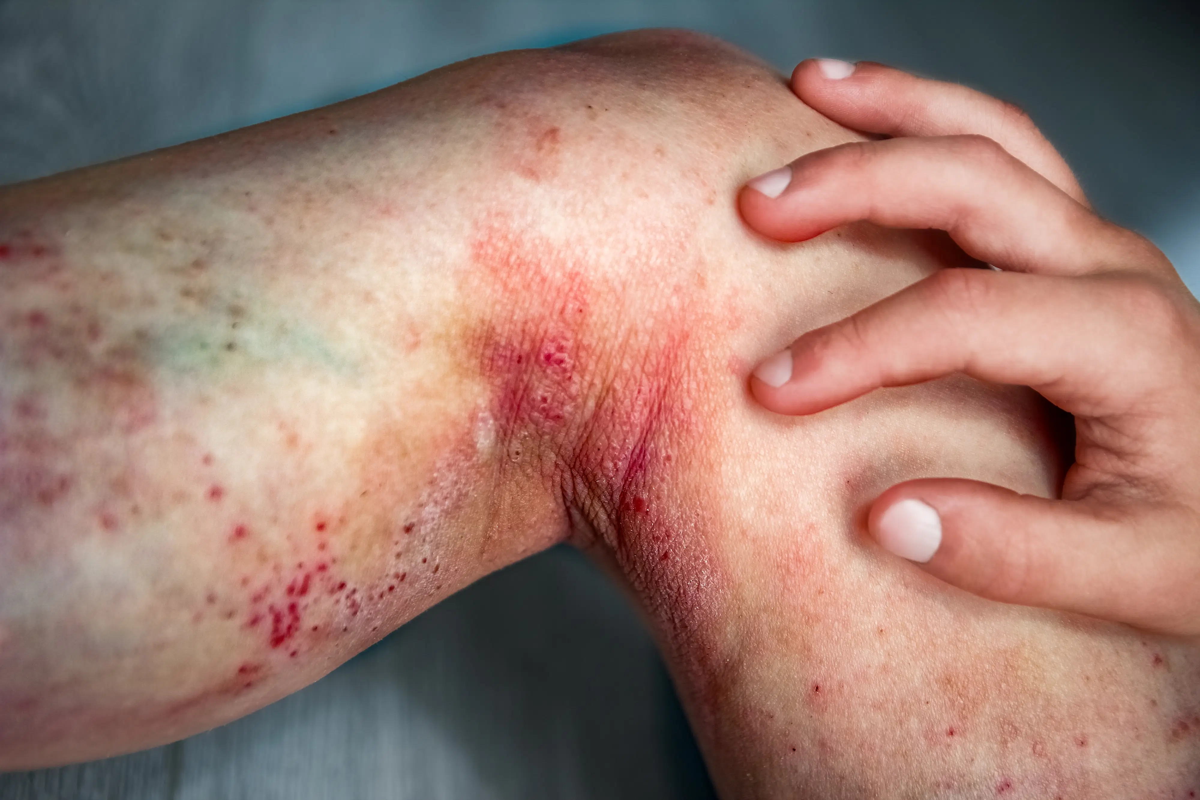Ayurvedic Treatments for Atopic Dermatitis in Kerala - Ayur Bethaniya